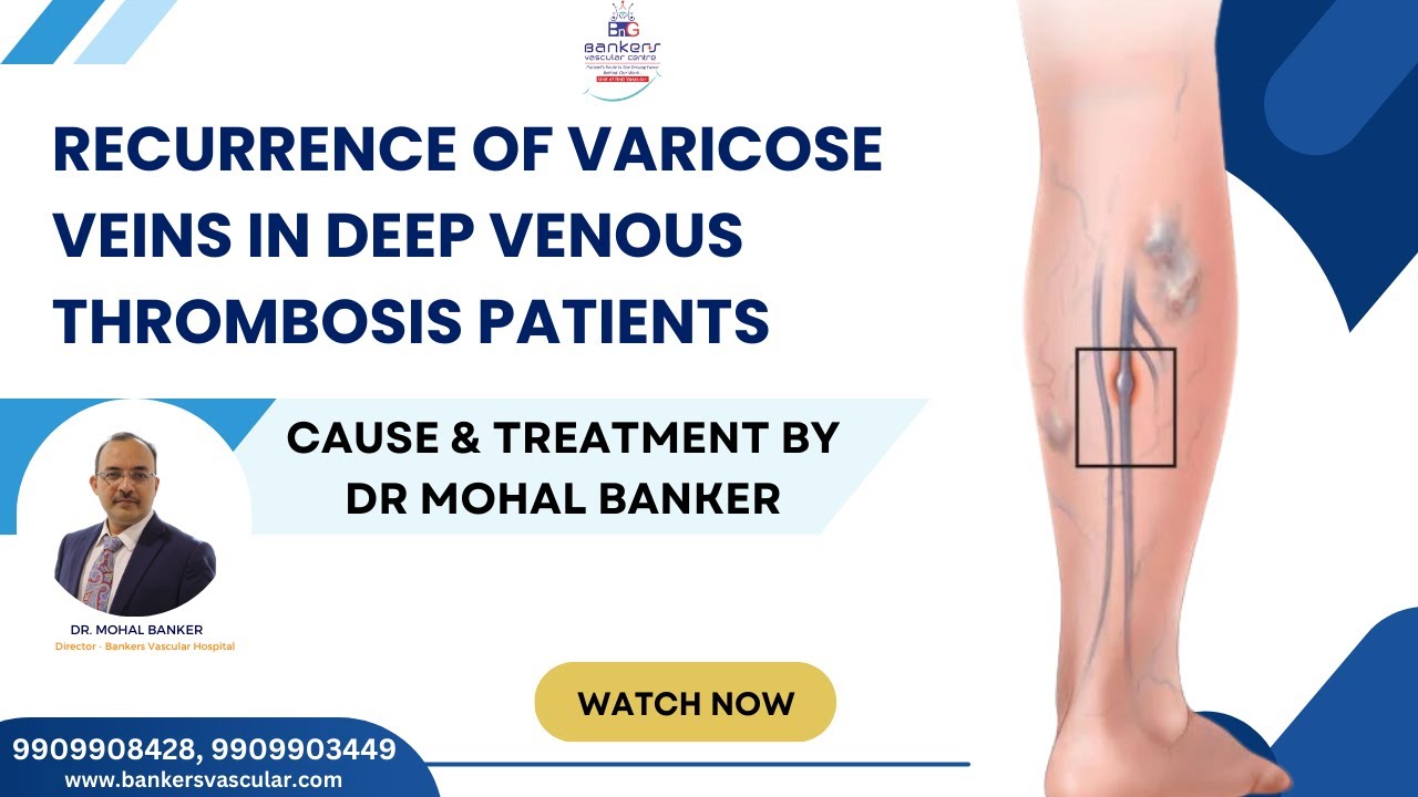 Recurrence of varicose veins in Deep Venous thrombosis patients-cause ...