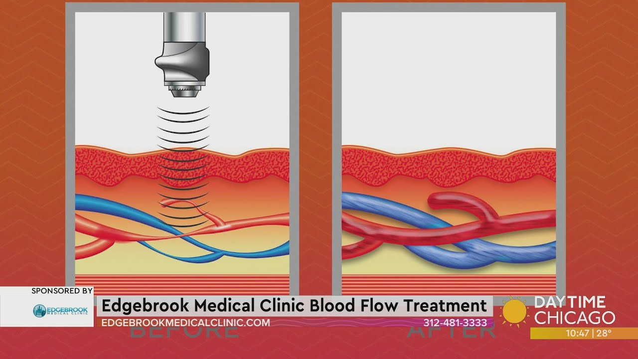 Edgebrook Medical Clinic Blood Flow Treatment - YouTube