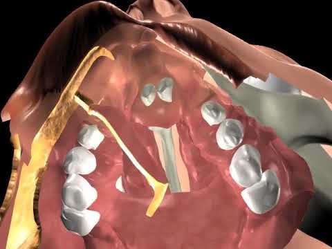 Facial Artery Musculo Mucosal Flap - YouTube