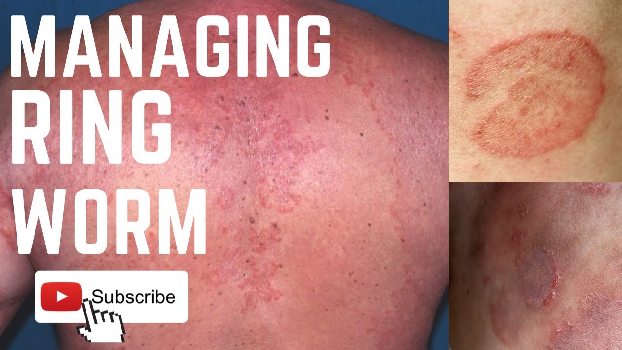 managing ringworm - YouTube