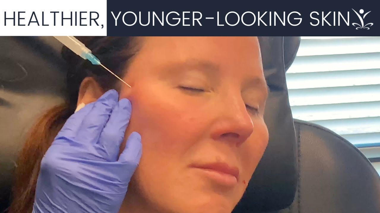 What is Sculptra? - YouTube