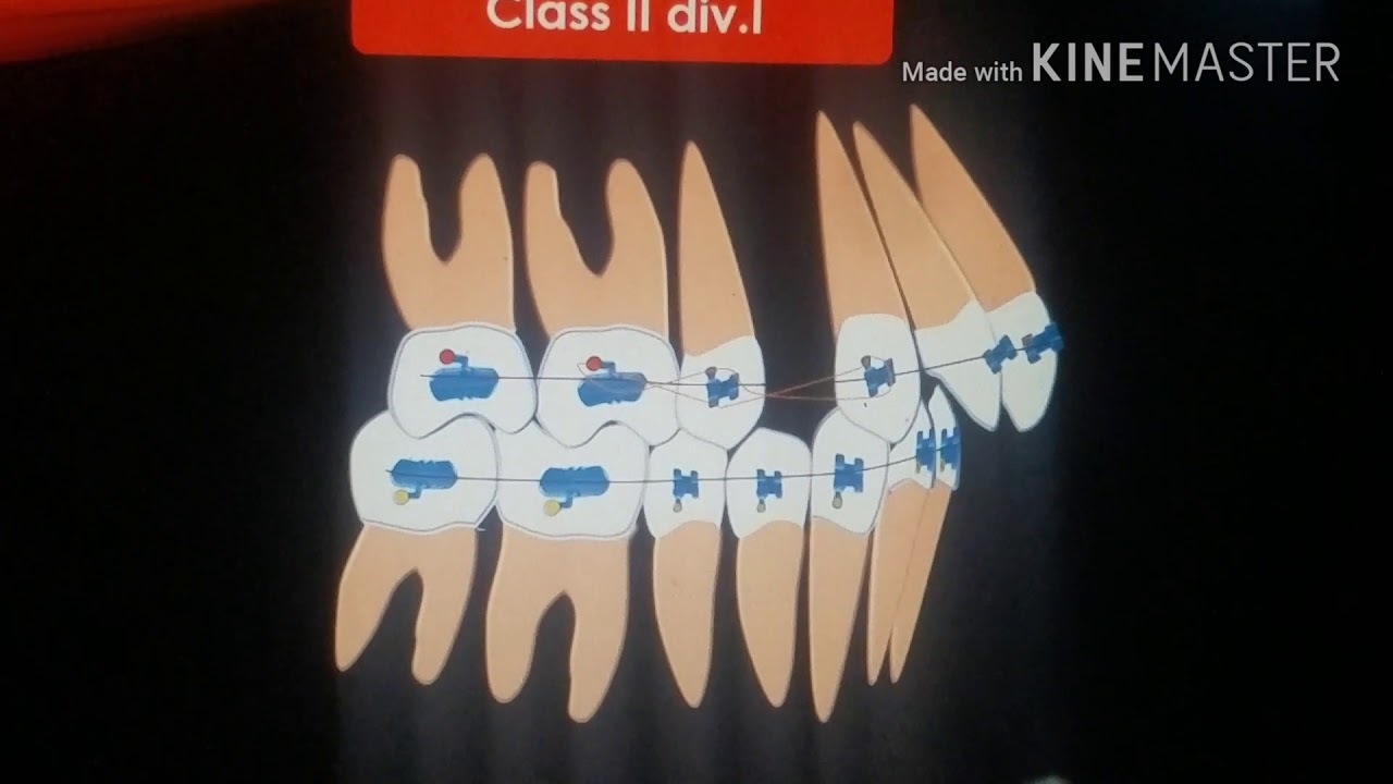 Treatment of class II div.I - YouTube