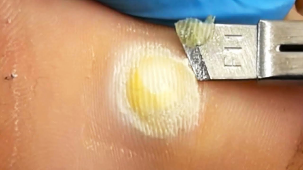 Carefully Scrape Off The Dead Skin On The Soles Of Your Feet And Clean ...