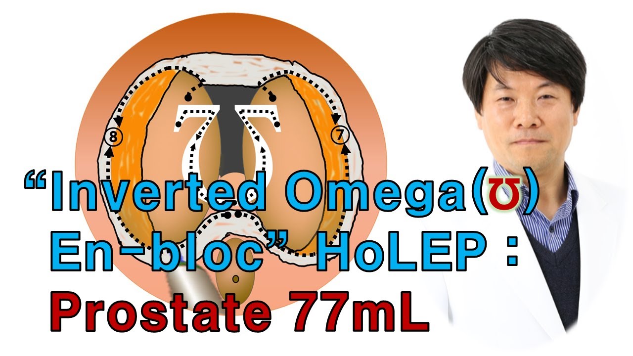 Inverted Omega En-bloc HoLEP technique: Prostate 77ml - YouTube