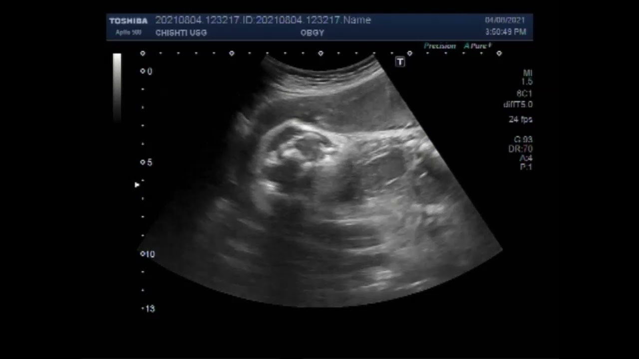 Pregnancy of about 32 weeks with Intrauterine fetal demise and a ...