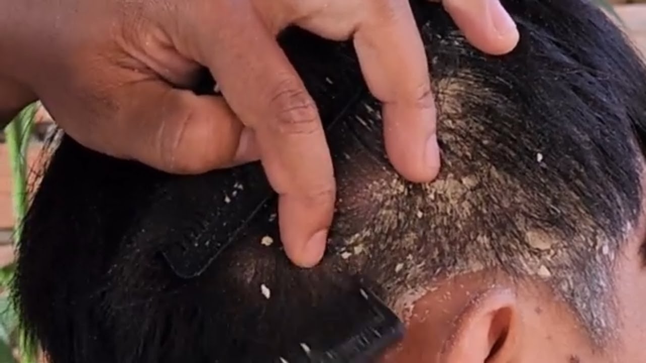 ASMR Scalp Scratching for Sleep and Relaxing Care #491 - YouTube