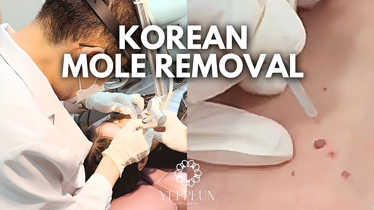 Korean Mole Removal with CO2 Laser: Fast, Safe & Scar-Free Solution # ...