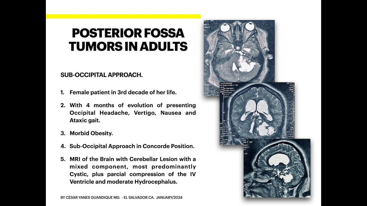 TUMOR OF THE POSTERIOR CRANIAL FOSSA. Microsurgical Resection. - YouTube