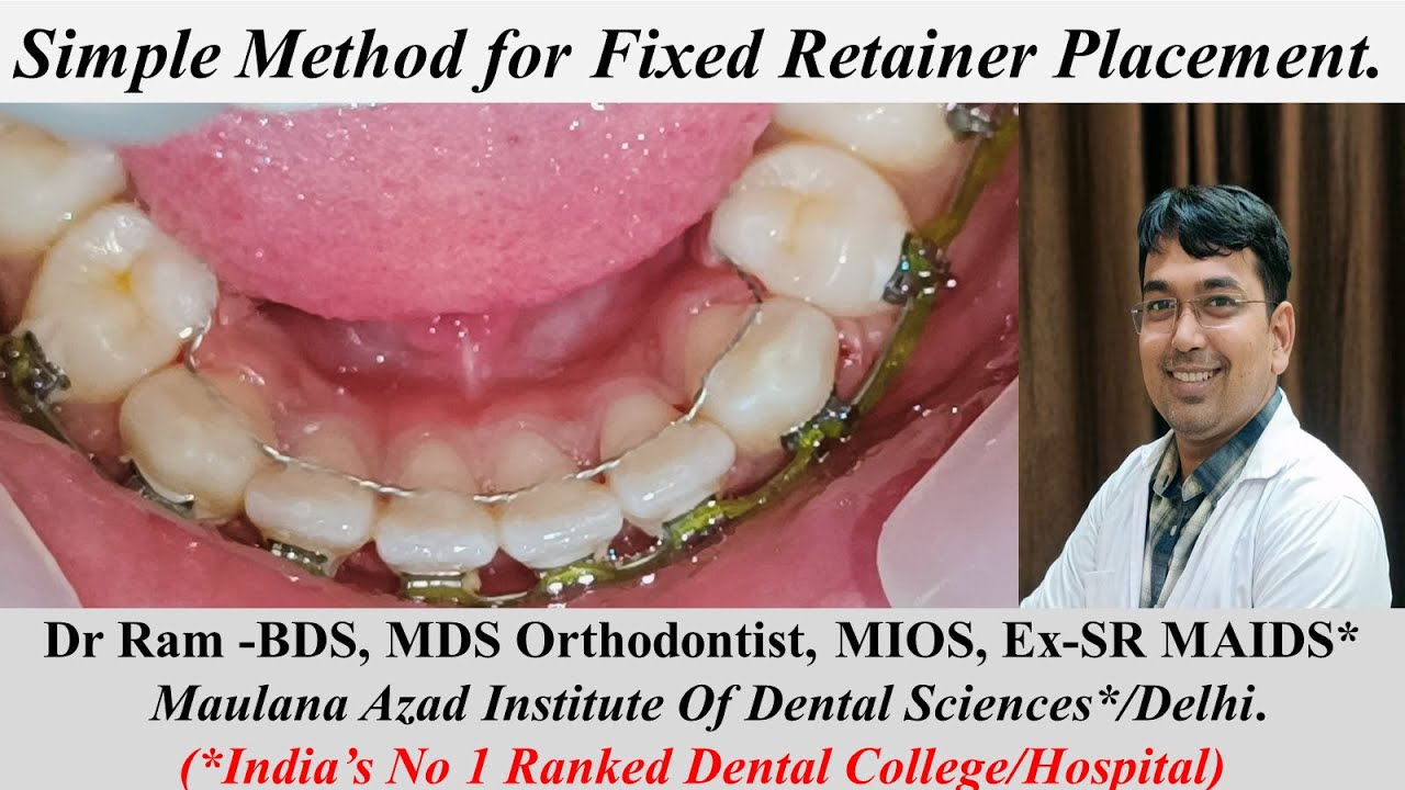 Fixed Retainer after Braces I ब्रेसेस के बाद फिक्स्ड रिटेनर कैसे लगाते ...