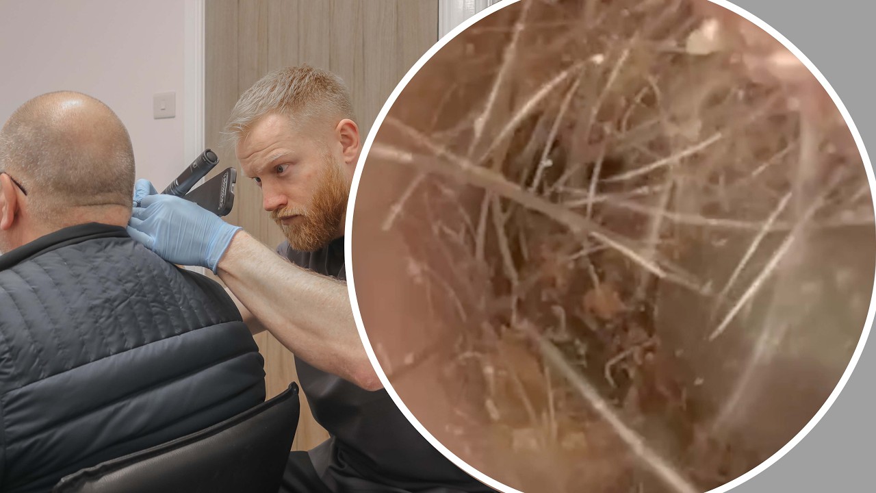 Tackling a VERY Hairy Ear Canal | Ear Wax Removal in Kenilworth #025 ...
