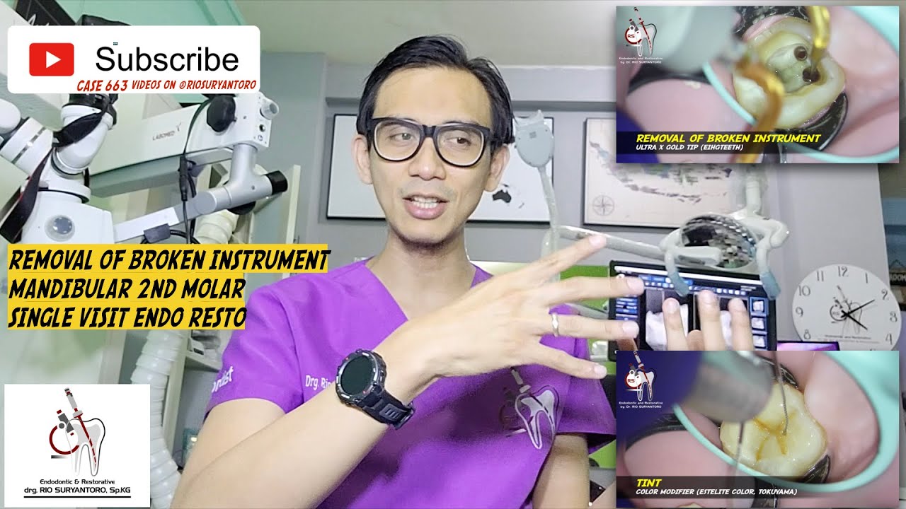 REMOVAL OF BROKEN ENDODONTIC INSTRUMENT MANDIBULAR 2ND MOLAR | SINGLE ...