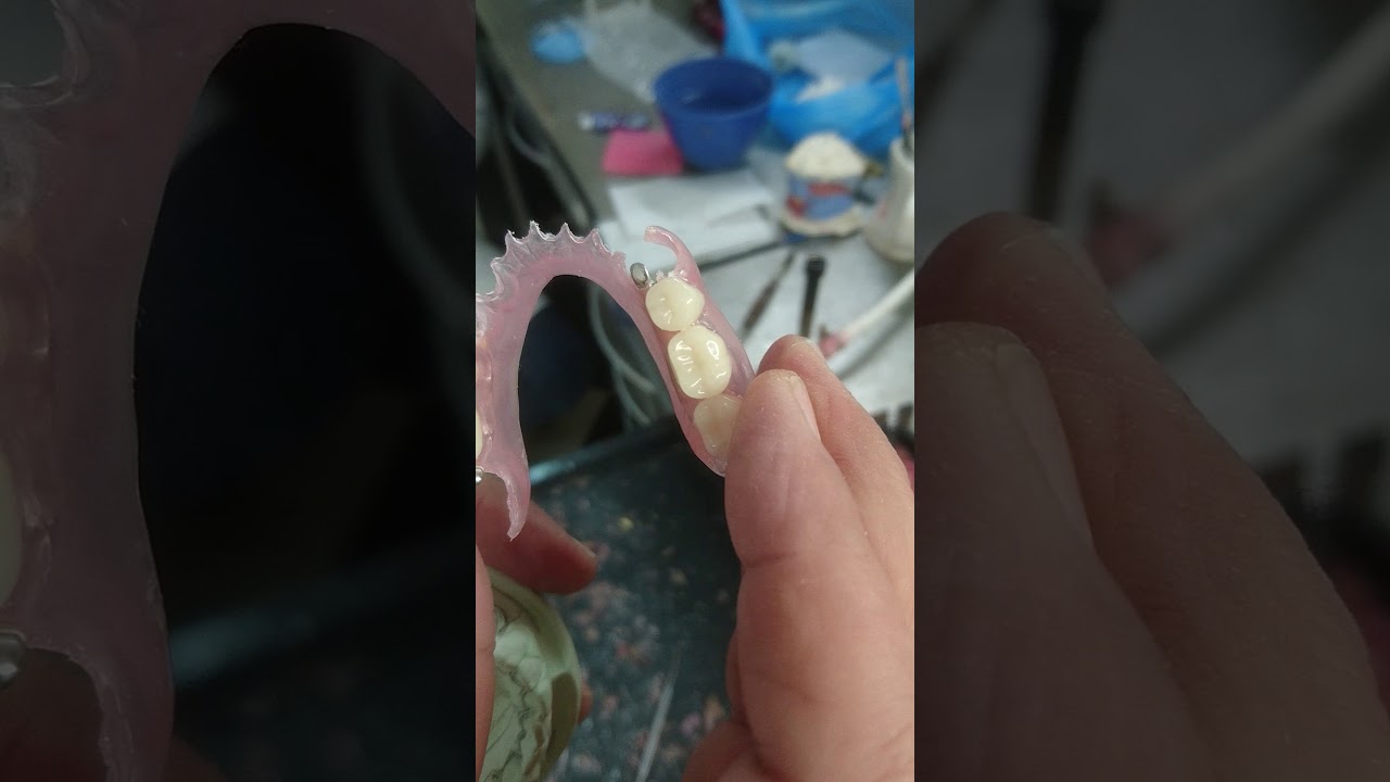 Prothèse partielle en résine flexible PARTIAL FLEX - YouTube