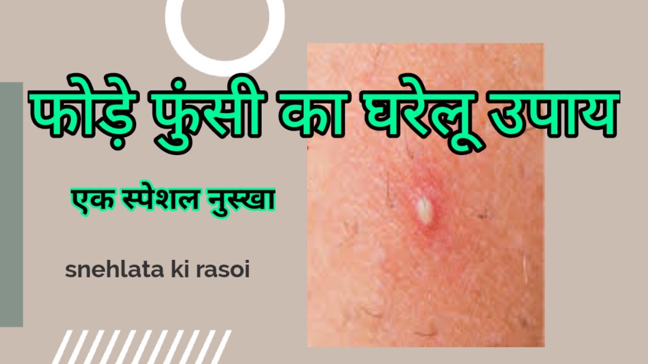 Fode Funsi Ka Gharelu Ilaj || HOMEMADE REMEDIES FOR ABSCESSES | Phoode ...