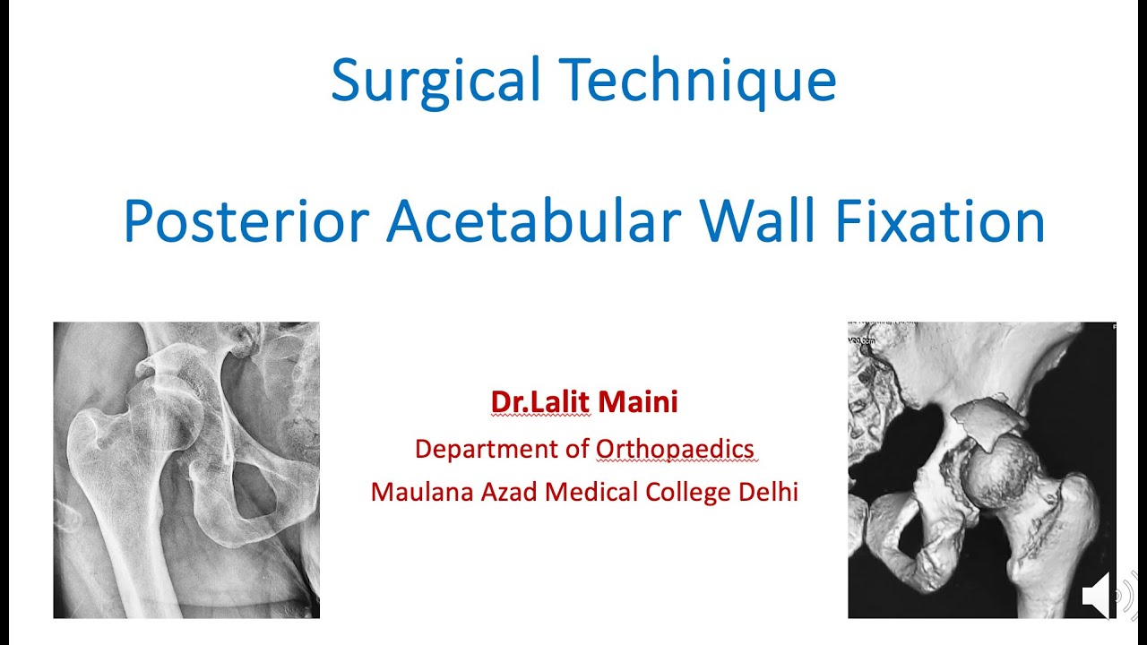 Technique Posterior Acetabular wall Fixation - YouTube