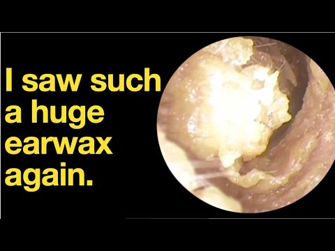 I saw such a huge earwax again. |ear wax removal | ear cleaning | ASMR ...