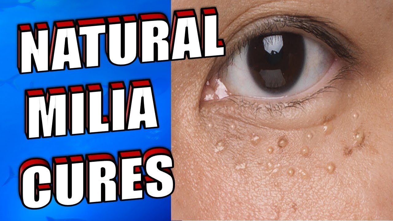 How To Get Rid Of White Fat Bumps Under Eyes NATURAL MILIA TREATMENT how-to-get-rid-of-white-fat-bumps-under-eyes-natural-milia-treatment