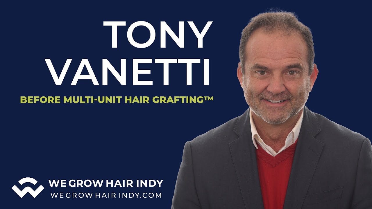 Tony Vanetti Gets a Hair Transplant - YouTube