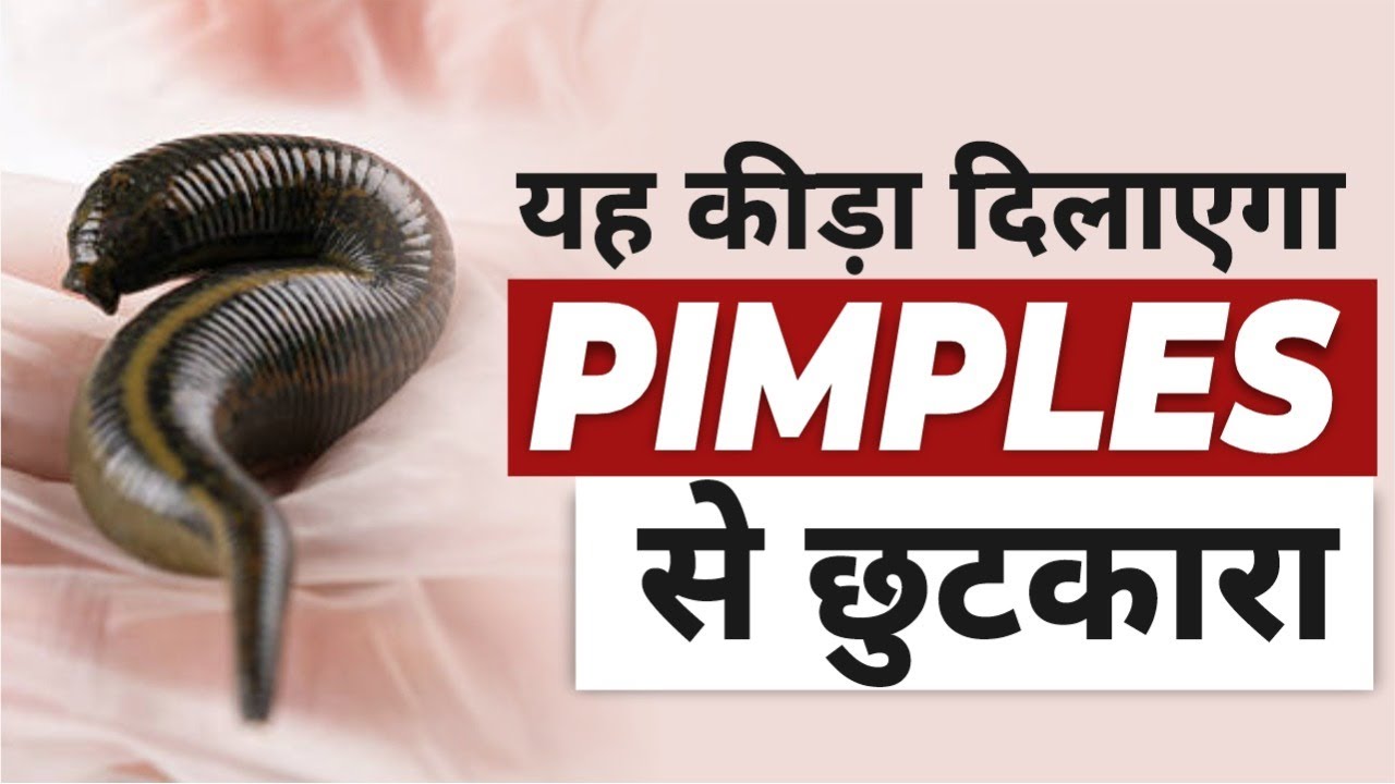 Acne Treatment | Leech Therapy for Pimples | Acharya Manish Ji | HiiMS ...