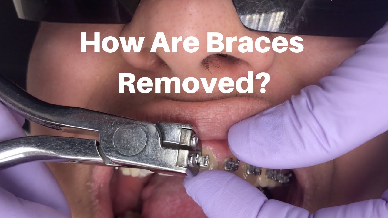 How Braces Are Removed In 2019 - YouTube