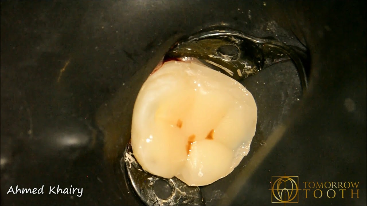 Direct Overlay composite restoration - YouTube