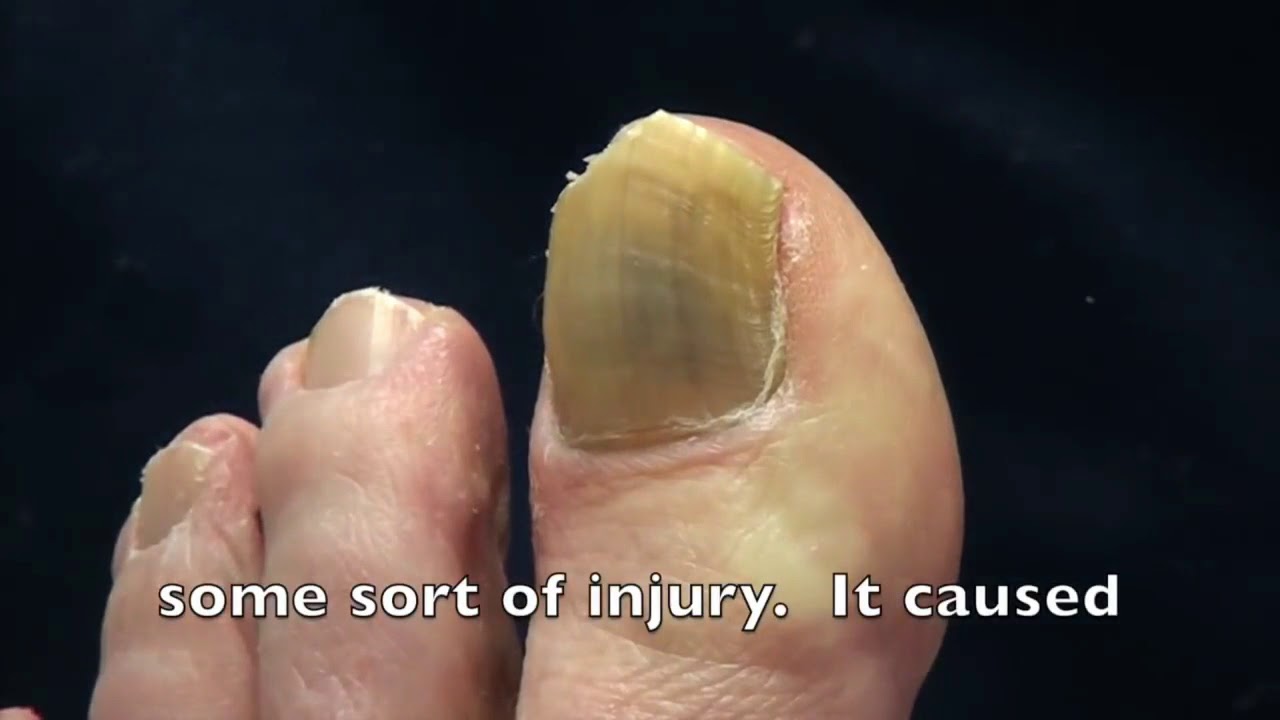 The Toenail Incident! Thick Nail Invasion 2018 - YouTube