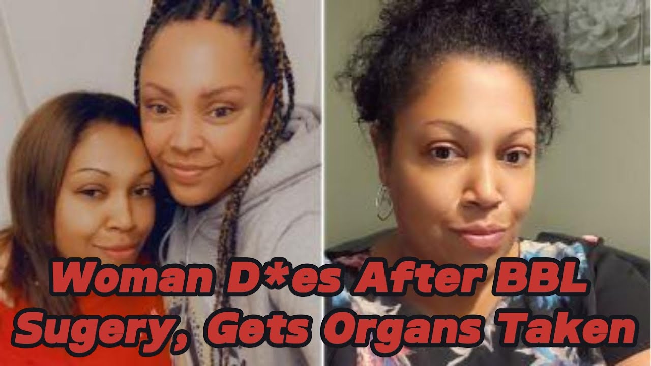 BBL Surgery in Turkey Turns Deadly And Patient Gets Her Organs Taken ...