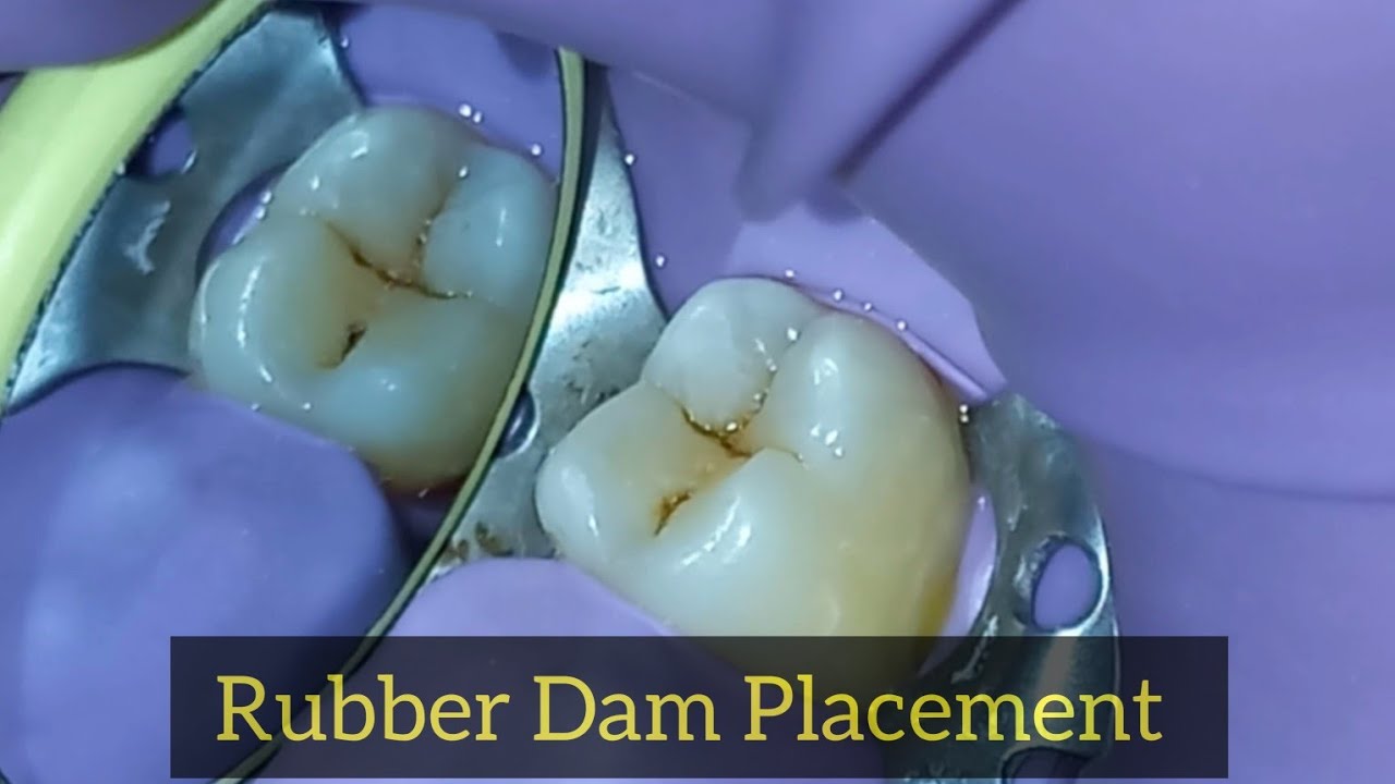How to Put Rubber Dam on Molar | Rubber Dam Placement on Posterior ...