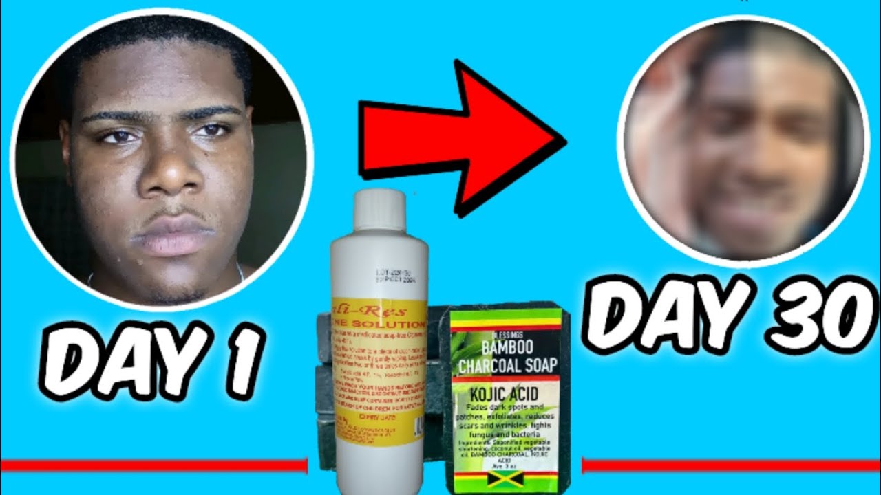 30 Days Using Bamboo Charcoal Soap & Sali Res Ance Solution! - YouTube