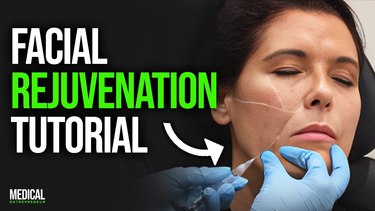 Under-Eye & Mid-Face Filler for Facial Rejuvenation | Full Procedure ...