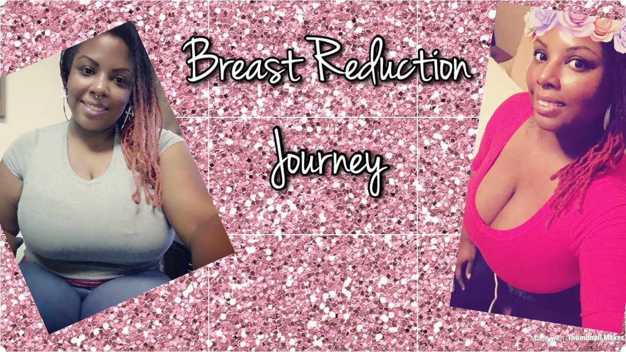 Insurance Company Approved Surgery Breast Reduction Youtube