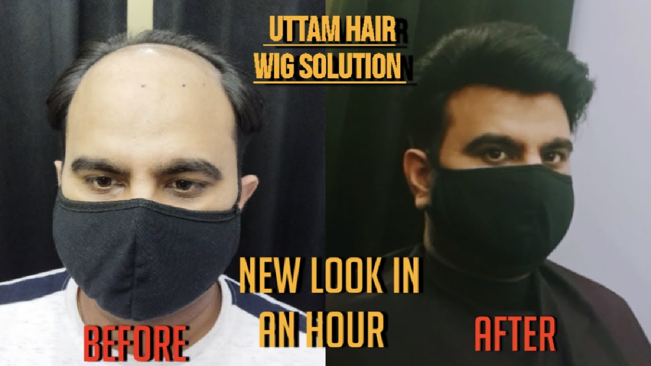 Customize hair patch for men | Front line hair patch in delhi | hair ...