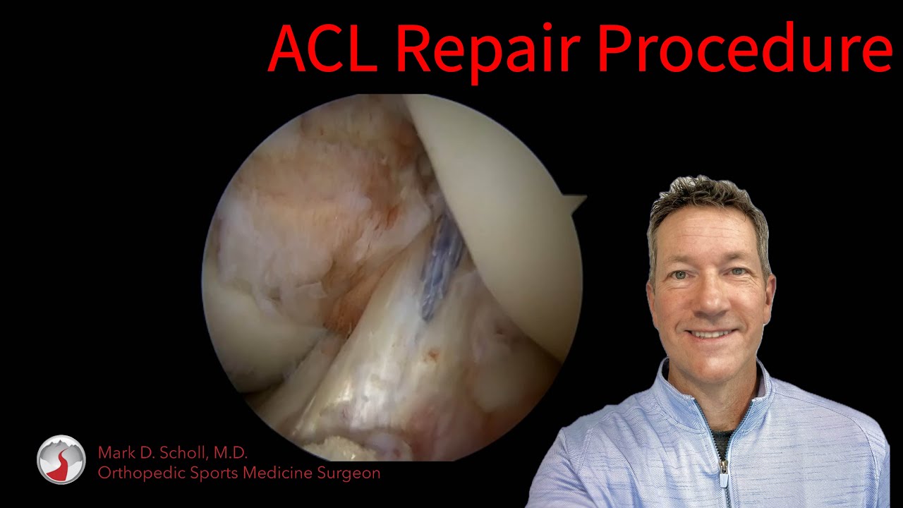 ACL Repair 2024 - YouTube