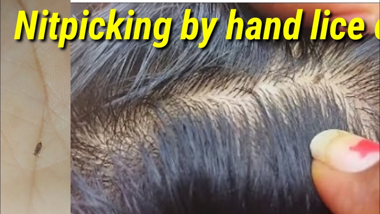 Nitpicking by shorts hair with real Sound heavy nits and lices - YouTube