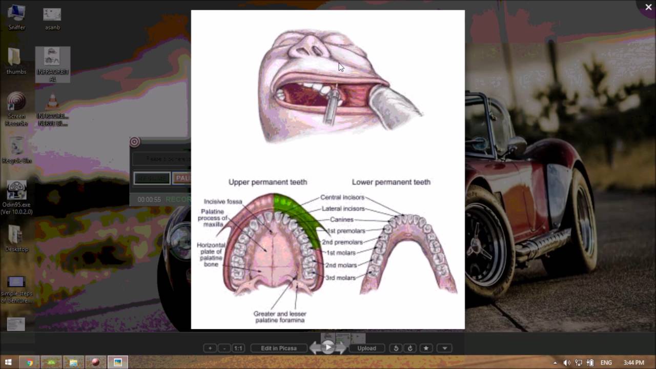 InfraOrbital Nerve Block- Basics - YouTube
