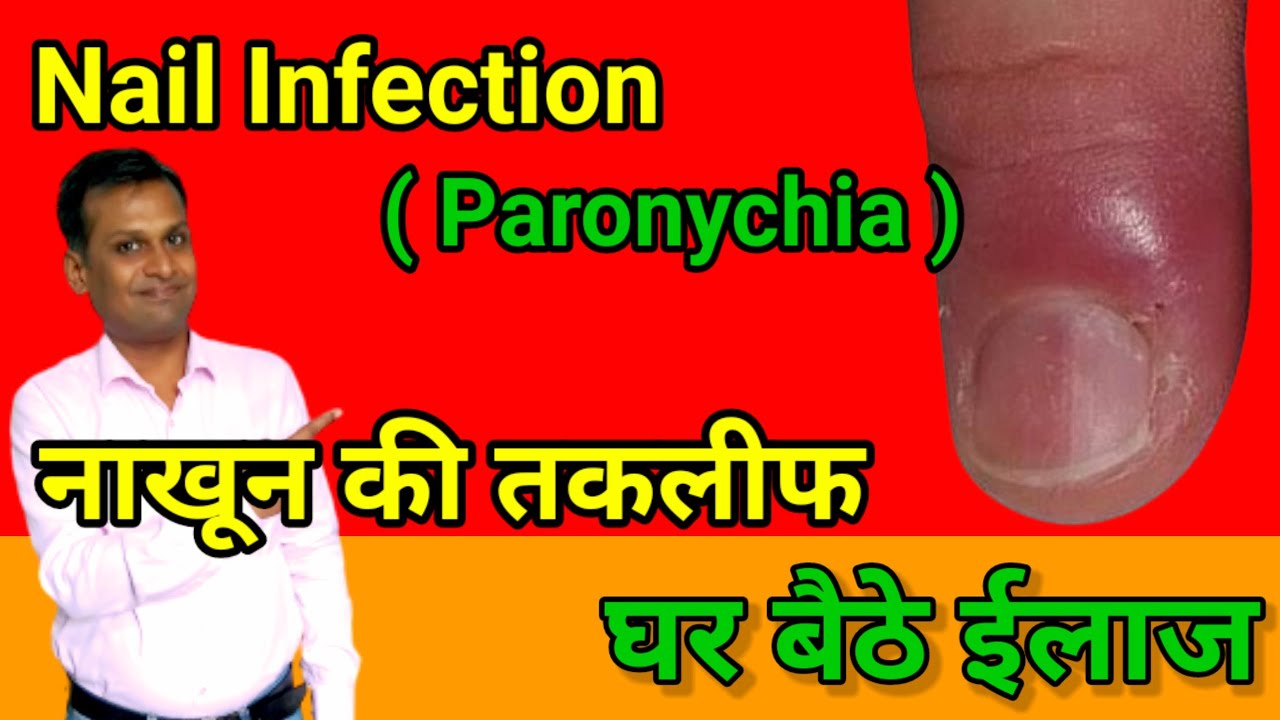 Paronychia /Finger nail infection - YouTube