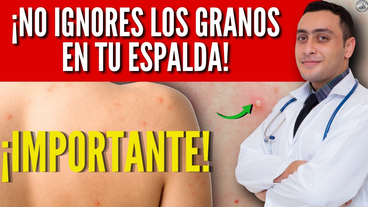 ¡Alerta de granos en la espalda! Descubre los peligros ocultos y cómo ...