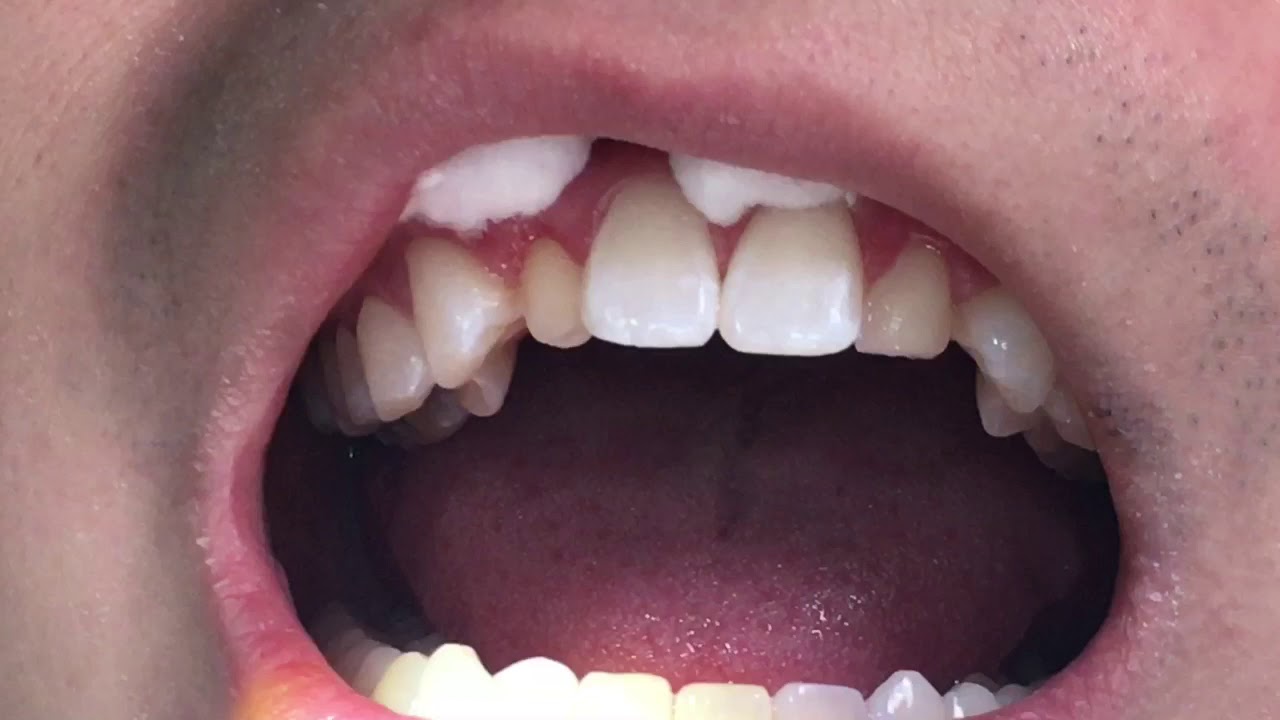 Houston Cosmetic Dentist..How just 2 veneers can change your smile ...