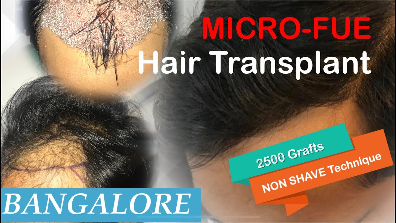Hair Transplant in Bangalore | Micro FUE, Non-Shave Technique for Hair ...