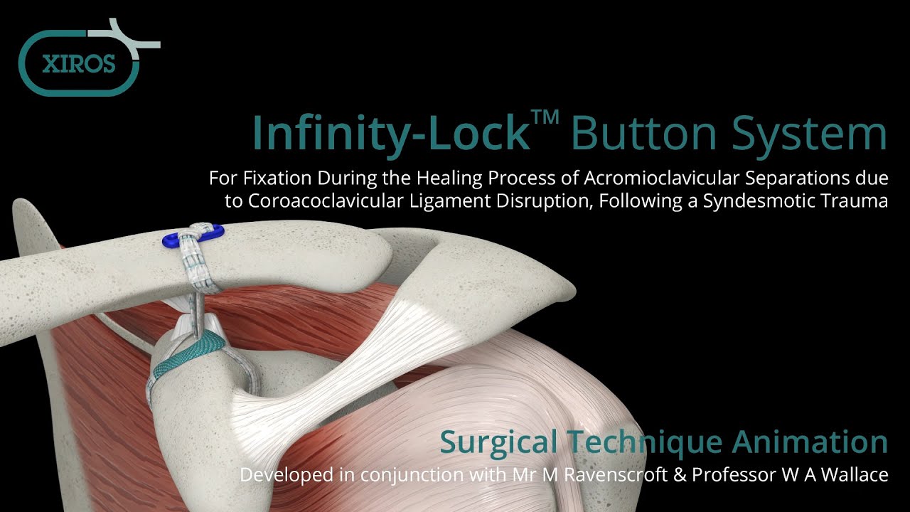 Infinity-Lock™ Button System Surgical Technique Animation - YouTube