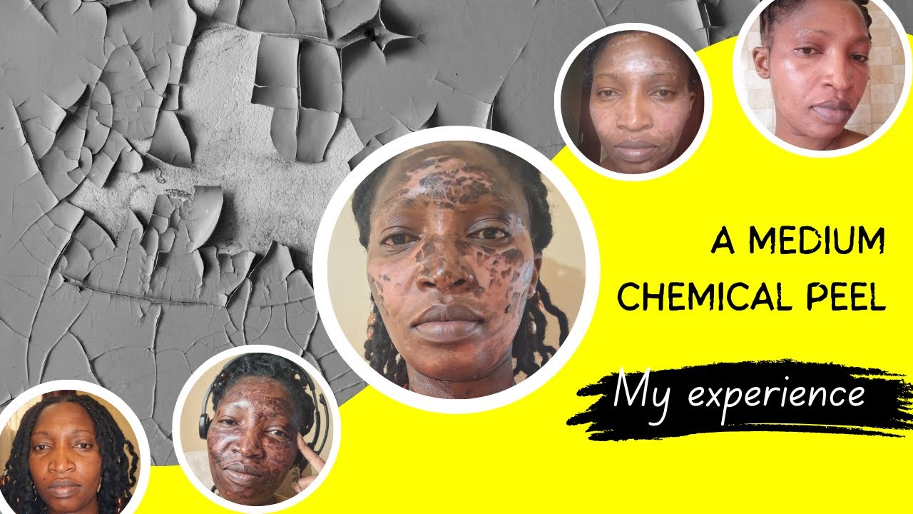 Watch this Before Doing a Medium Depth Chemical Peel! - YouTube