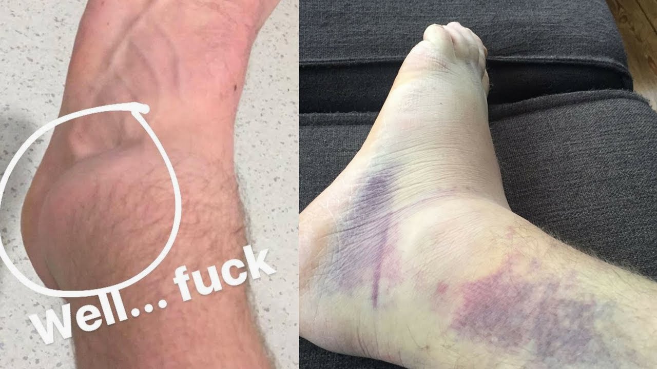 MY FIRST PARKOUR INJURY! TORE MY LATERAL LIGAMENT - YouTube