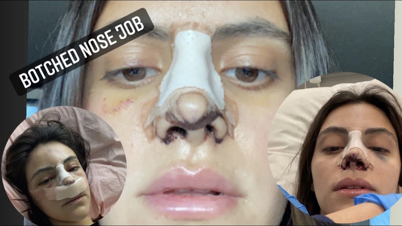 WOKE UP BOTCHED FROM SURGERY. my botched nose job journey PART 1 - YouTube
