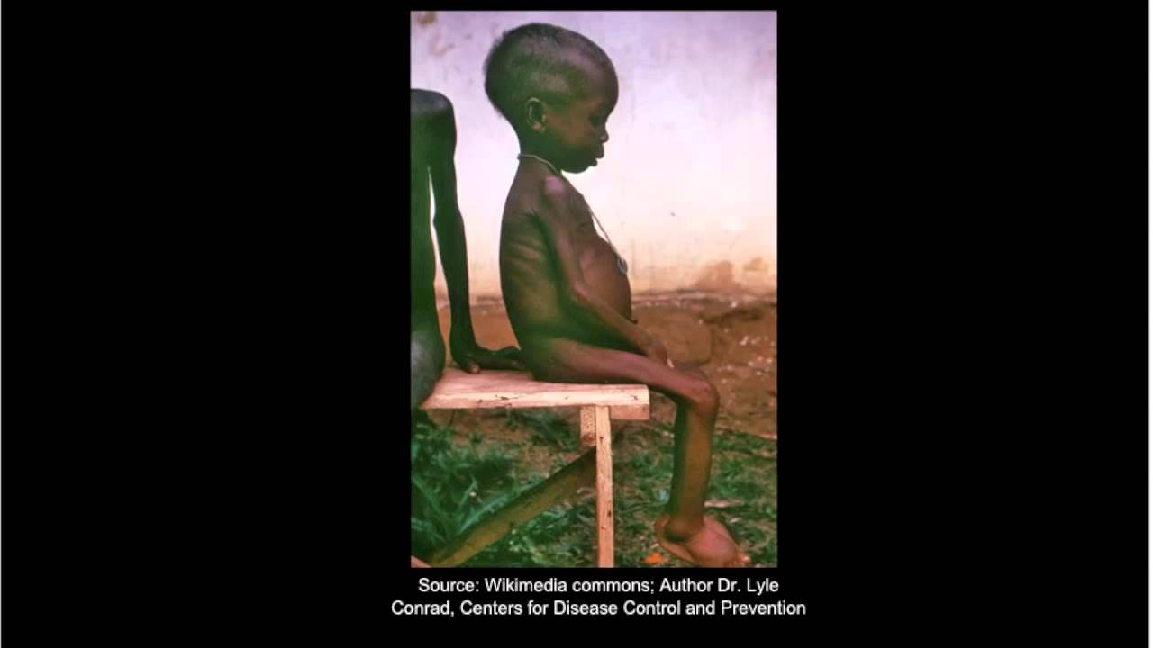 A.1.4 Outline the consequences of protein deficiency malnutrition - YouTube