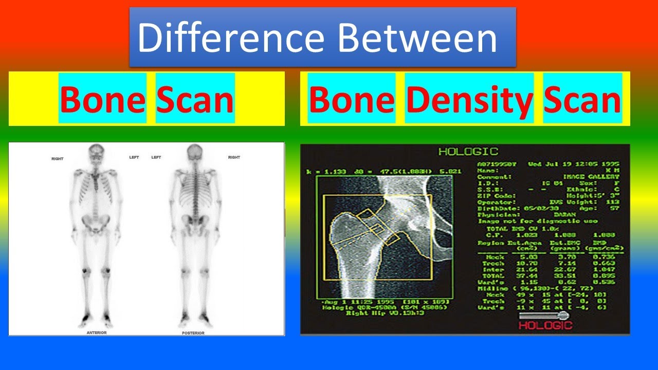 Difference Between Bone Scan And Bone Density Scan YouTube difference-between-bone-scan-and-bone-density-scan-youtube