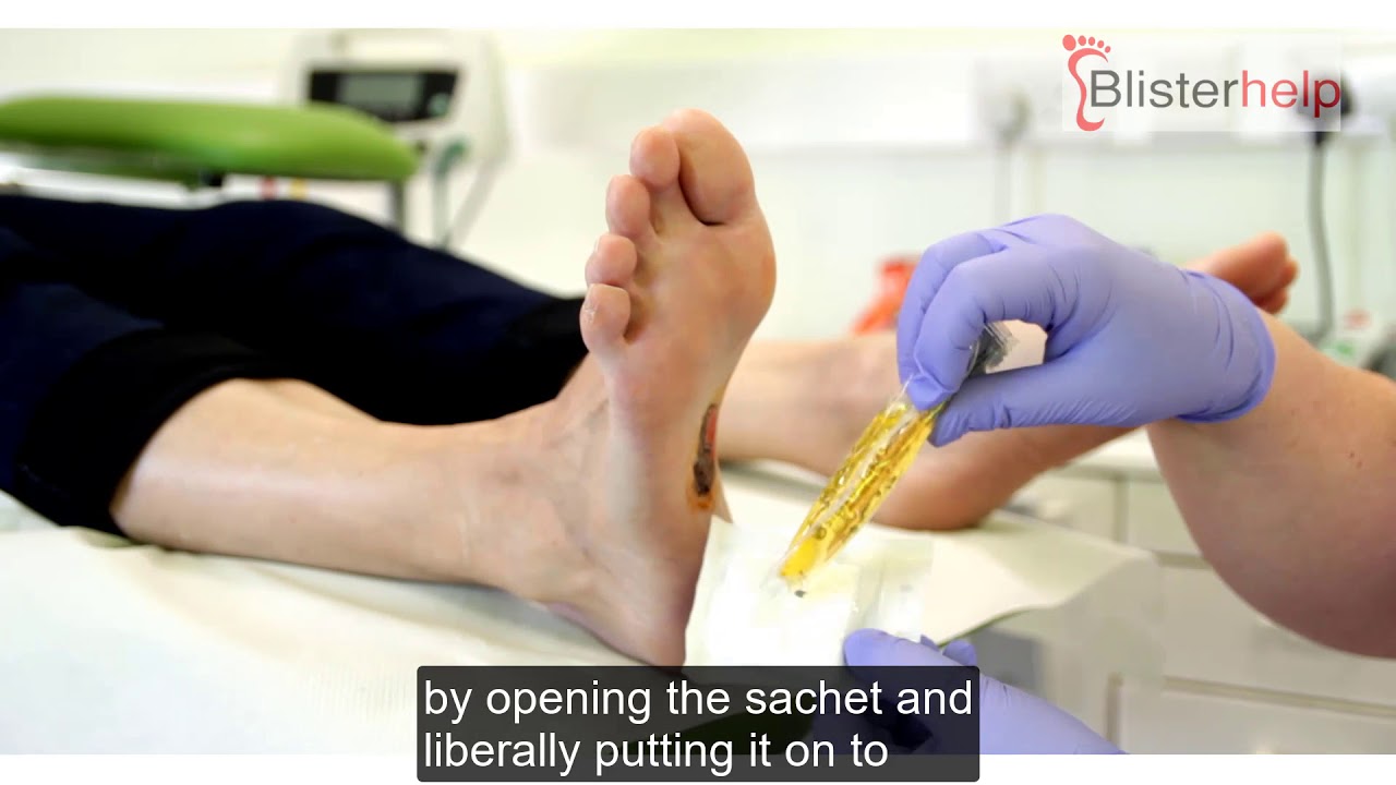 How to treat a Roof Torn Blister - YouTube