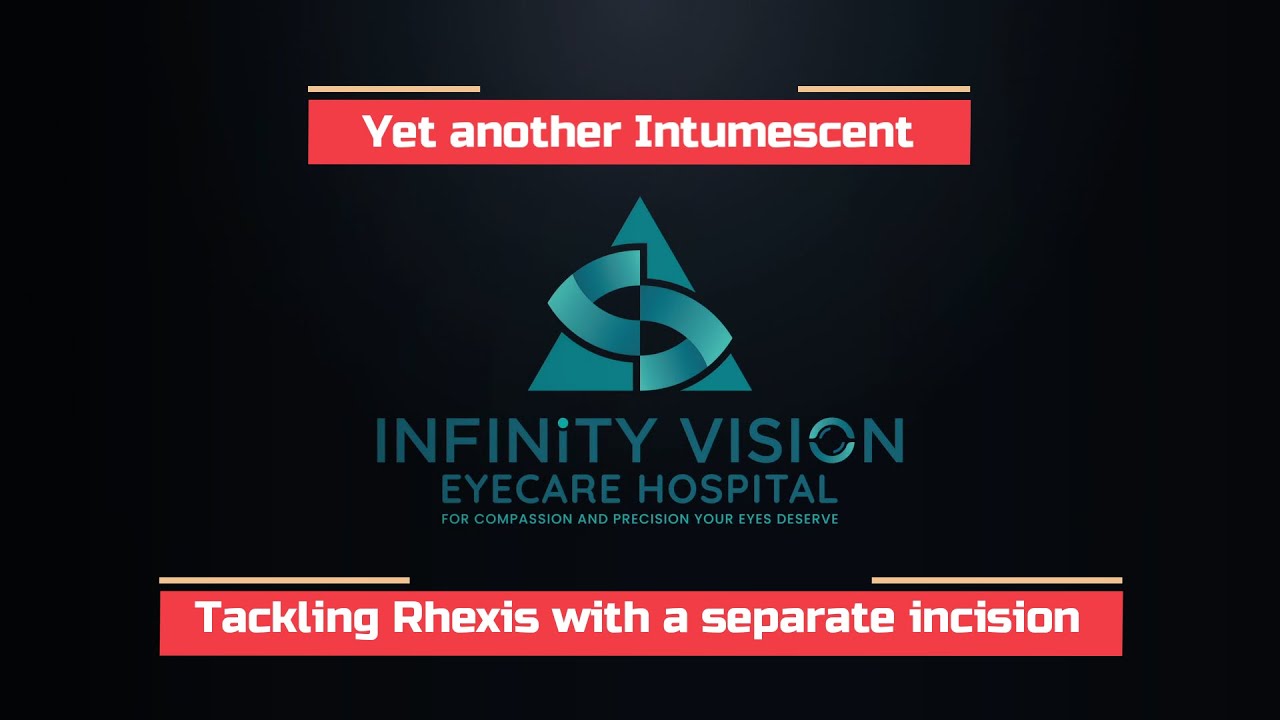 Tackling Rhexis in Intumescent Cataract - Vertical Chop - Dr Shylesh ...