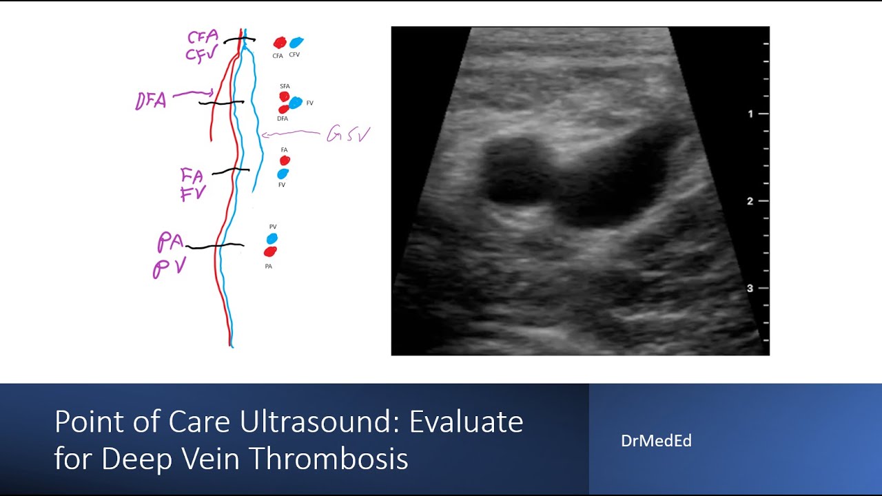 Point of Care Ultrasound (POCUS) - Evaluating Deep Vein Thrombosis ...