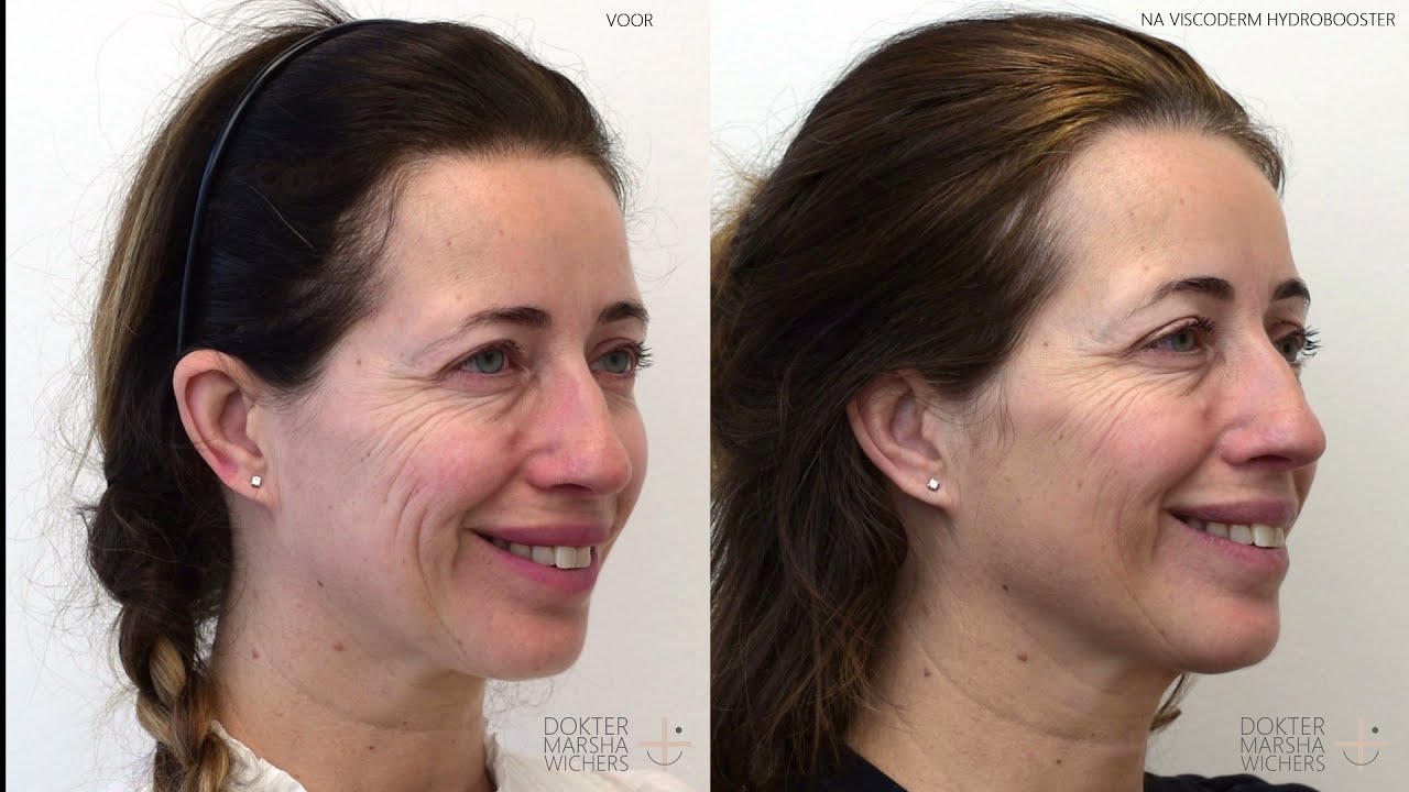 Viscoderm Hydrobooster® voor en na - YouTube