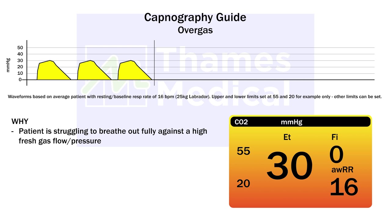 Capnography Waveforms: Overgas - YouTube