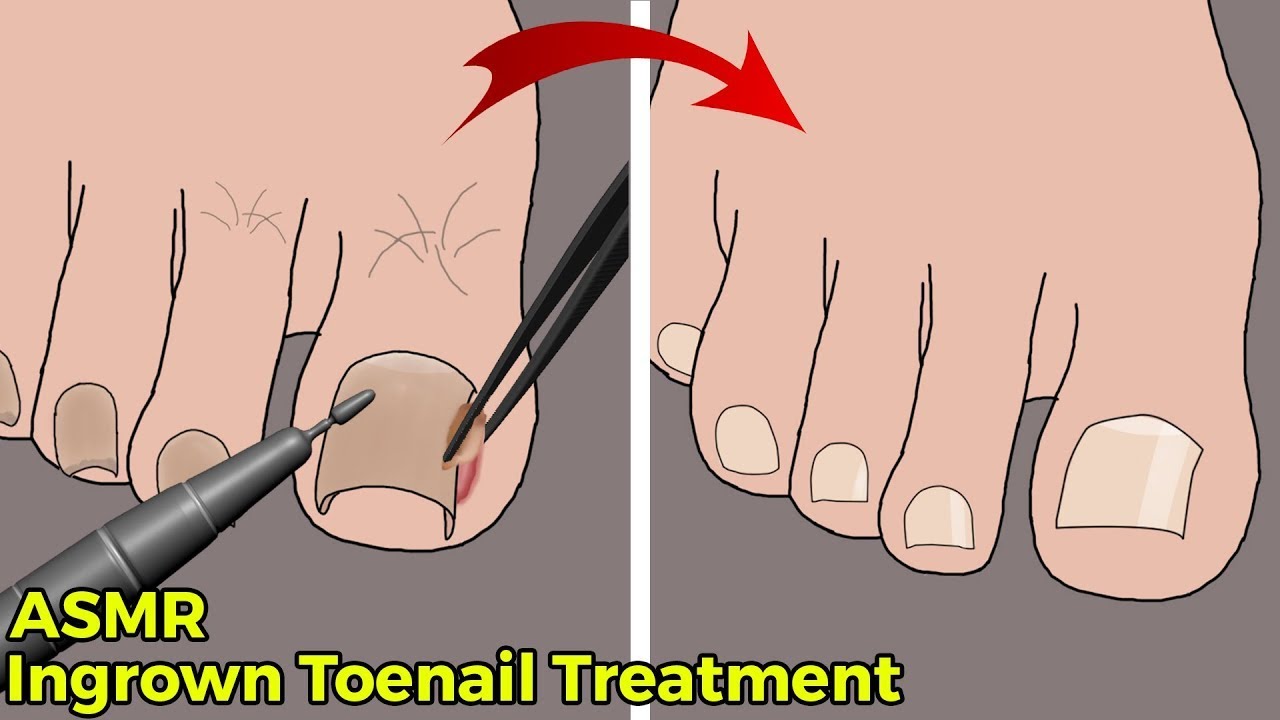 ASMR Ingrown Toenail removal treatment animation II KIAF QADEER - YouTube